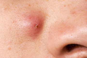 What is the Difference Between Cysts and Abscess - thedailyactivist.com